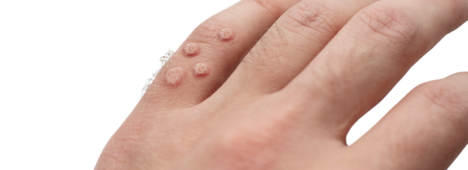 Wrat | Oorzaak en behandeling | Sproet