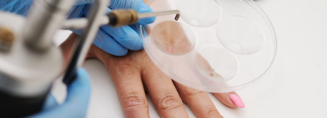 Wrat | Oorzaak en behandeling | Sproet