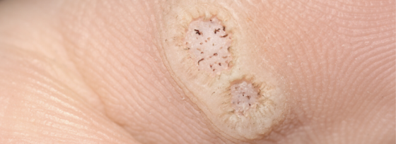 Wrat | Oorzaak en behandeling | Sproet