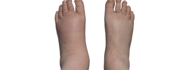 Lymfoedeem benen, arm | Behandelen | Sproet