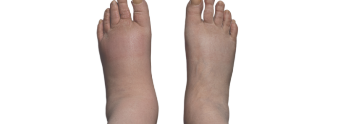 Lymfoedeem benen, arm | Behandelen | Sproet