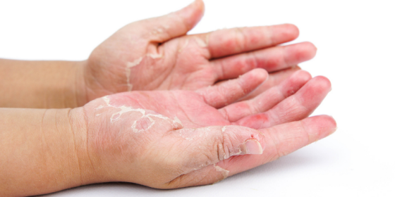 Voetschimmel | Jeuk onder voeten | Oplossing | Sproet