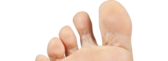 Voetschimmel | Jeuk onder voeten | Oplossing | Sproet