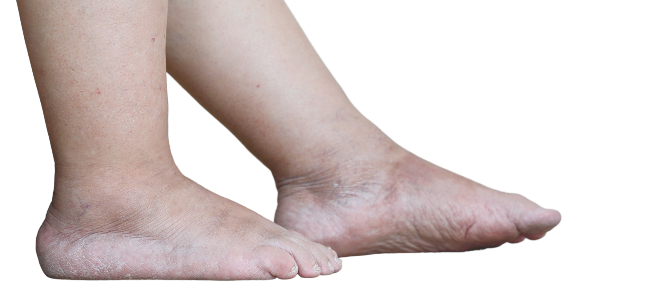 Lymfoedeem benen, arm | Behandelen | Sproet