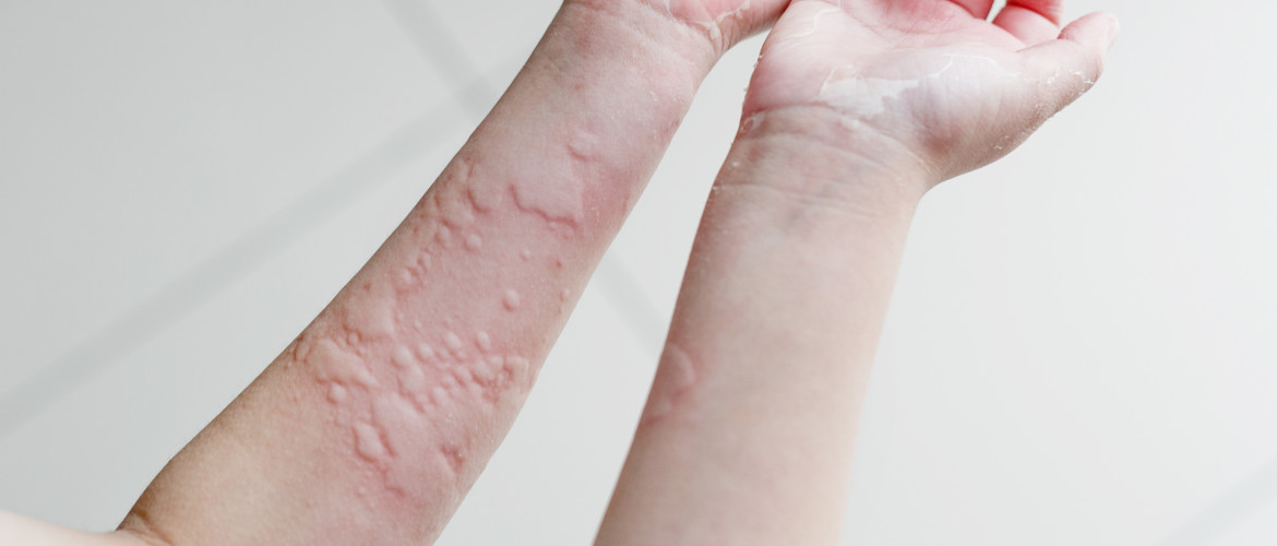 Urticaria: jeukende rode galbulten