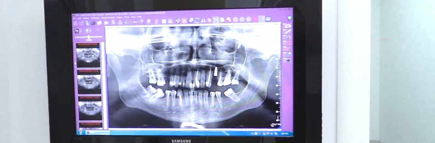 Rontgenfoto Gebit Laten Maken | Achterhaal DIRECT jouw Gebitsproblemen!