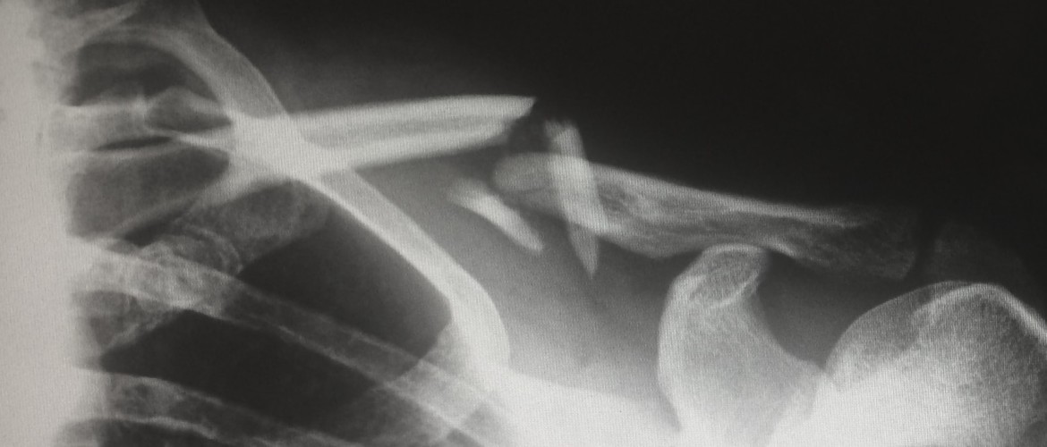 Optimaal genezen na een botbreuk, hoe doe je dat?