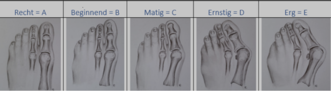 Tapen van hallux valgus bij cliënten